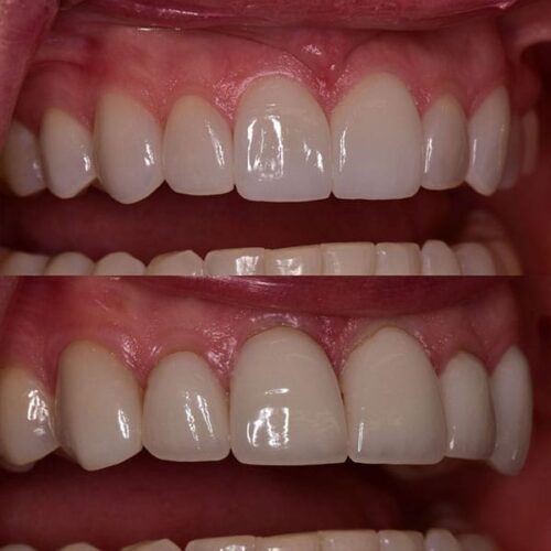 Before & After | Orlando Family & Cosmetic Dentistry