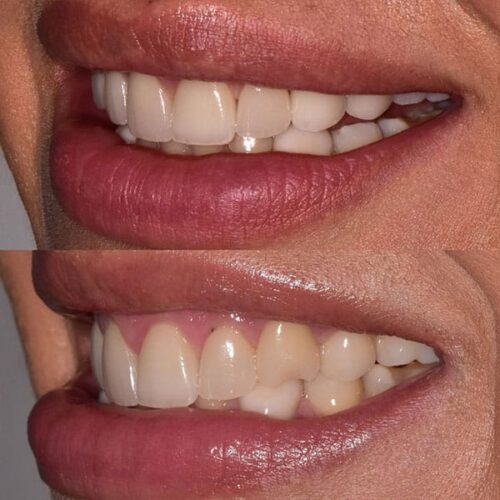 Before & After | Orlando Family & Cosmetic Dentistry